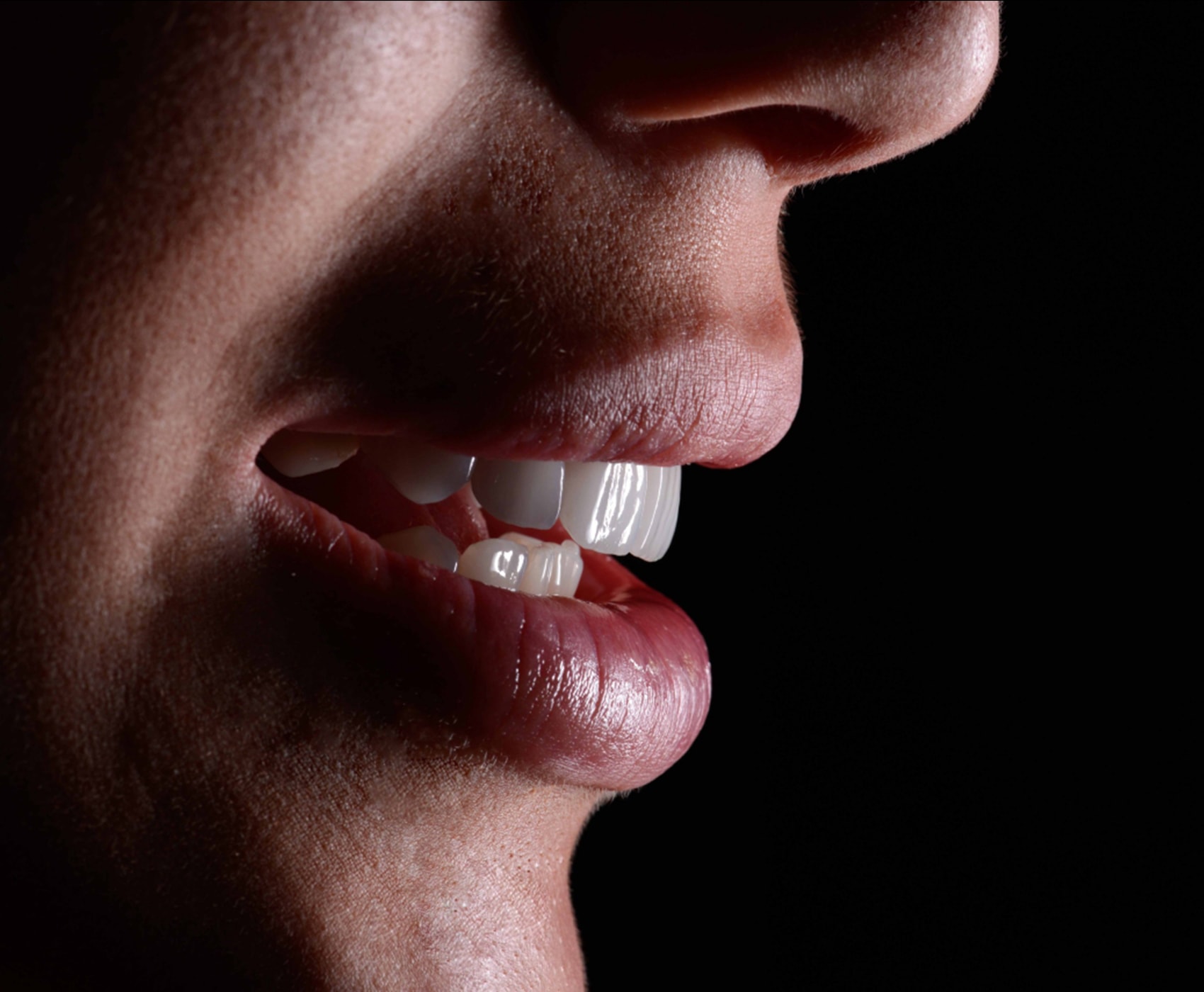 Metal-free bleach crowns - Dental Inpuls