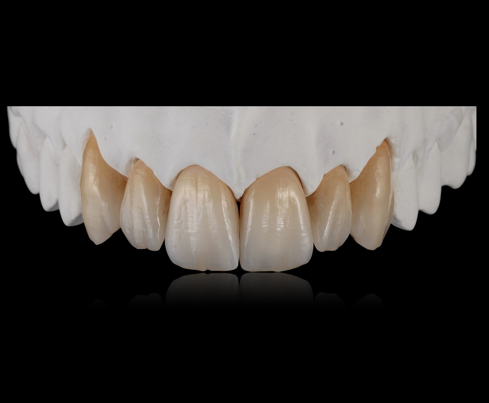 ICN monolithic zirconia - Dental Inpuls